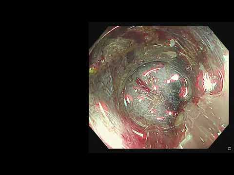 Colon ESD- Ascending colon 3cm post tattooing and biopsy with fibrosis ...