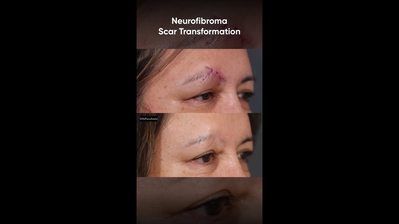 Neurofibroma Excision and Scar Transformation (SalehiMD) - YouTube