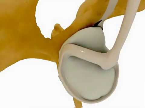 SLAP Lesion Type 4: Understanding and Treatment SLAP 병변 Type 4: 이해와 치료 ...