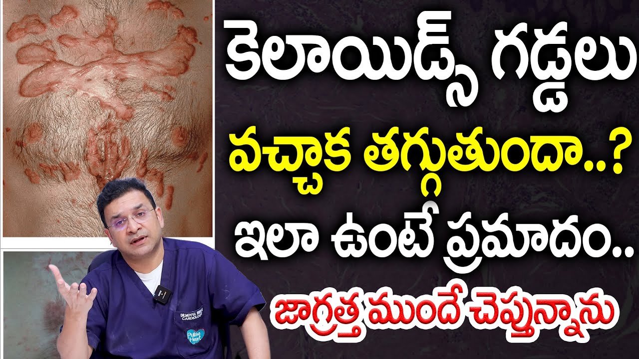 Dr. Movva Srinivas | What is the best treatment for Keloid in young ...