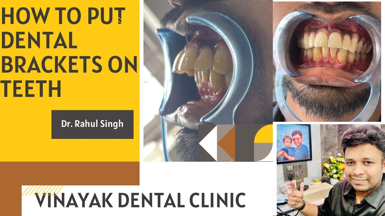 Comprehensive Guide to🦷 Brackets Placement in Upper and Lower Arches 😲 ...