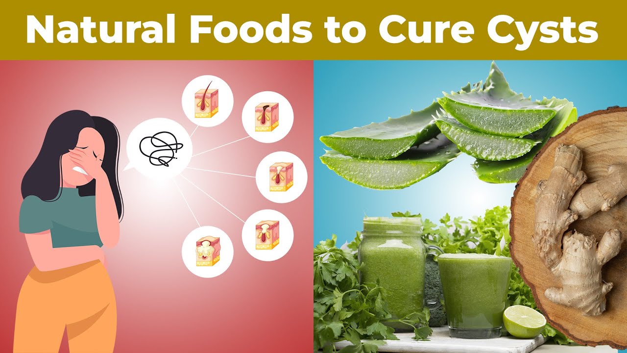 How to Cure Cysts in Women? Foods to AVOID! - YouTube