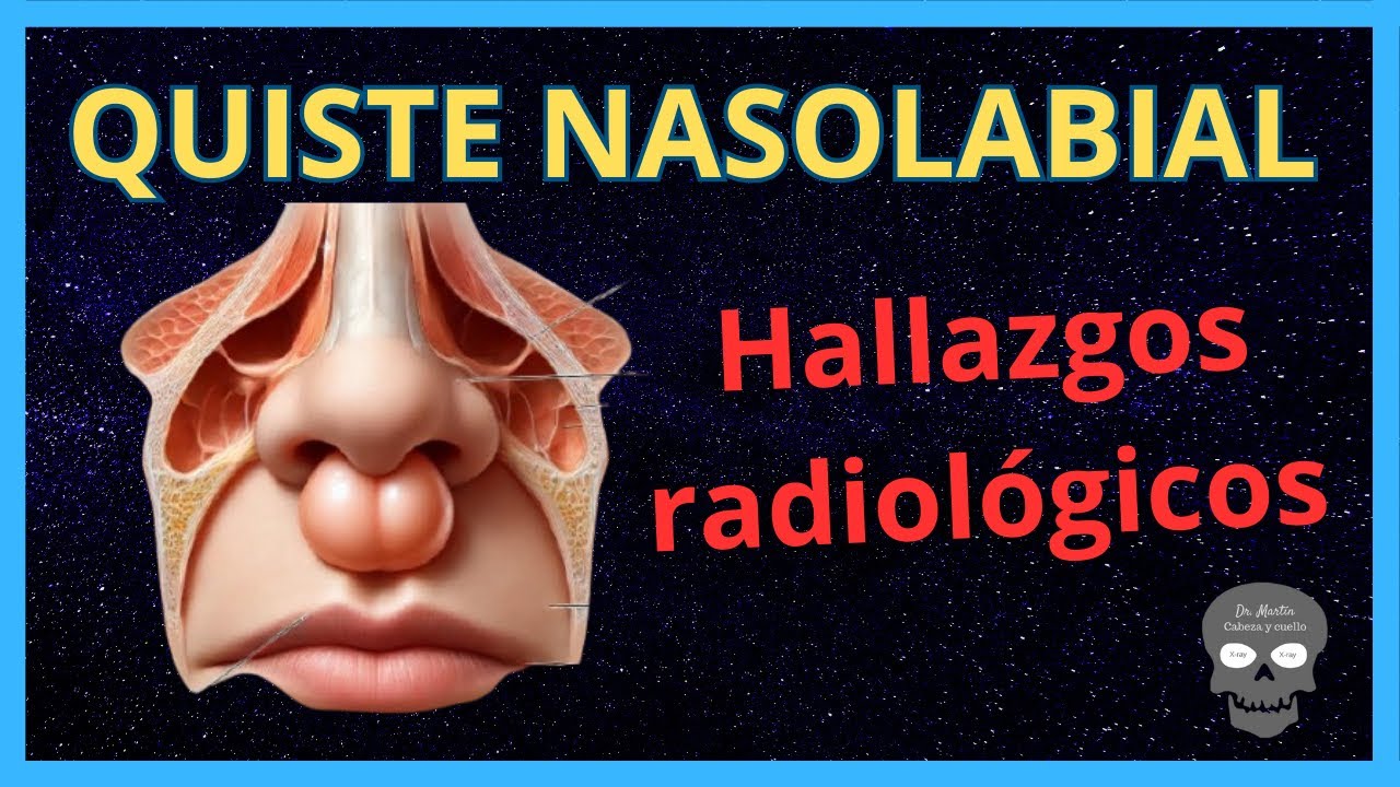 🔎 Quiste Nasolabial: 🩻 Diagnóstico y Hallazgos Radiológicos Explicados ...