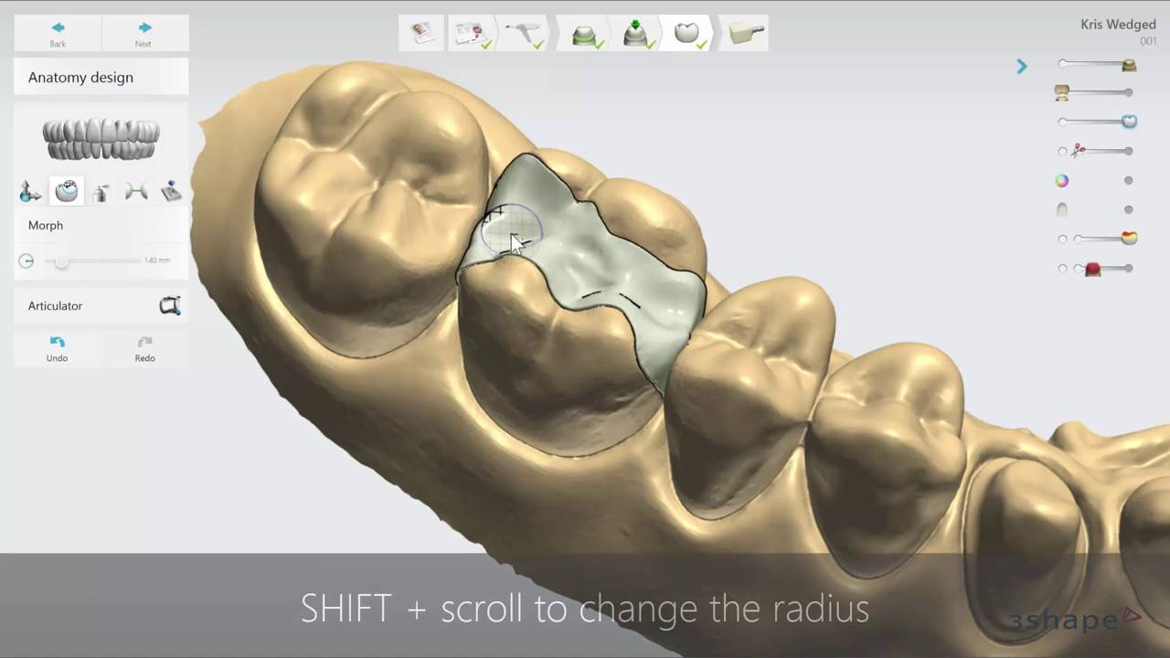 Premolar Onlay Prep Design - Design Talk