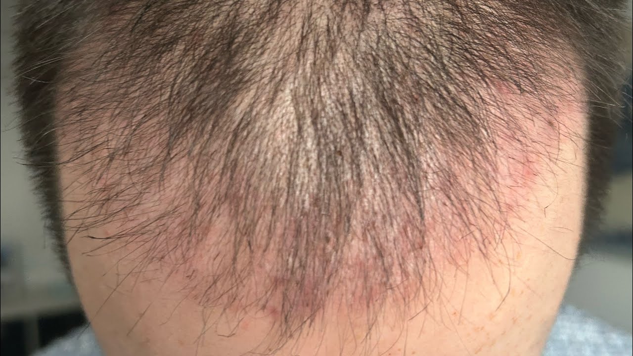 2 Monate nach der Haartransplantation - Haarwurzeln im Winterschlaf ...