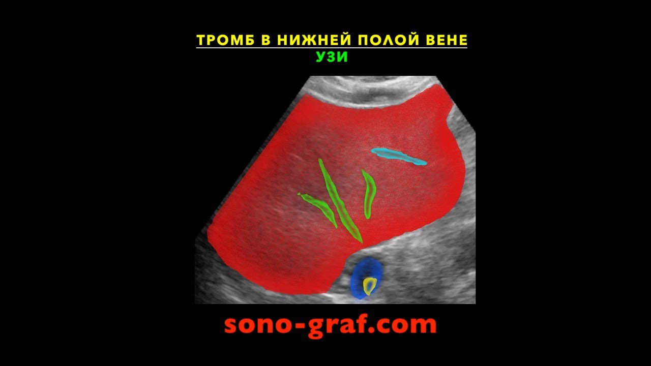 УЗИ Тромб в нижней полой вене Youtube