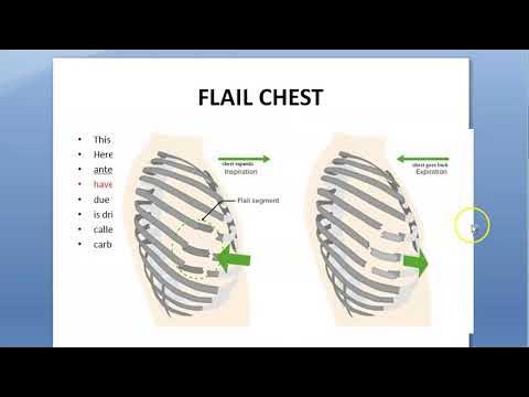 Flail Chest Diagram