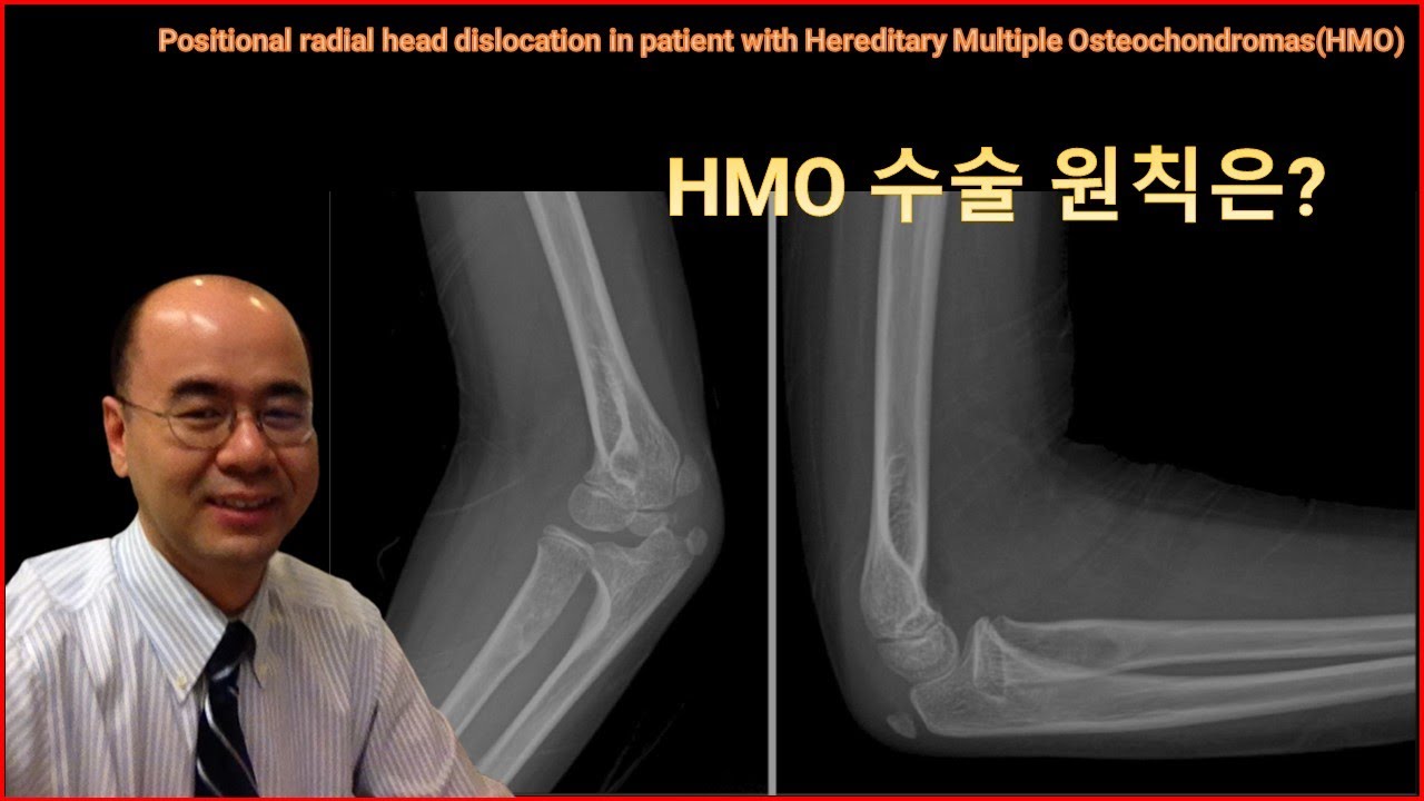 EP32. Positional radial head dislocation in patient with HMO(Hereditary ...