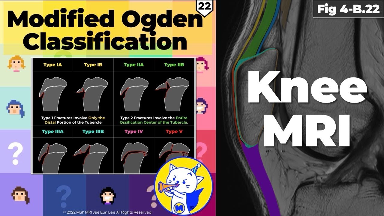 (Fig 4-B.22) Modified Ogden Classification - YouTube