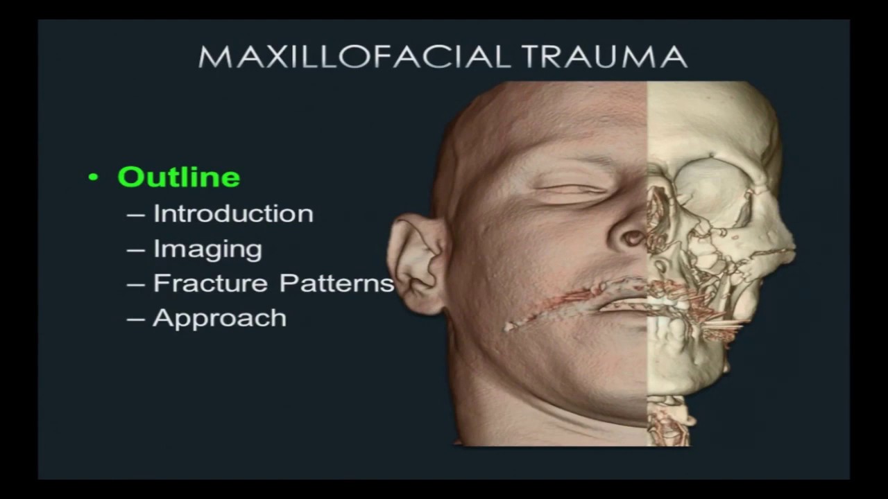 Face Trauma CT Emergency Radiology YouTube face-trauma-ct-emergency-radiology-youtube