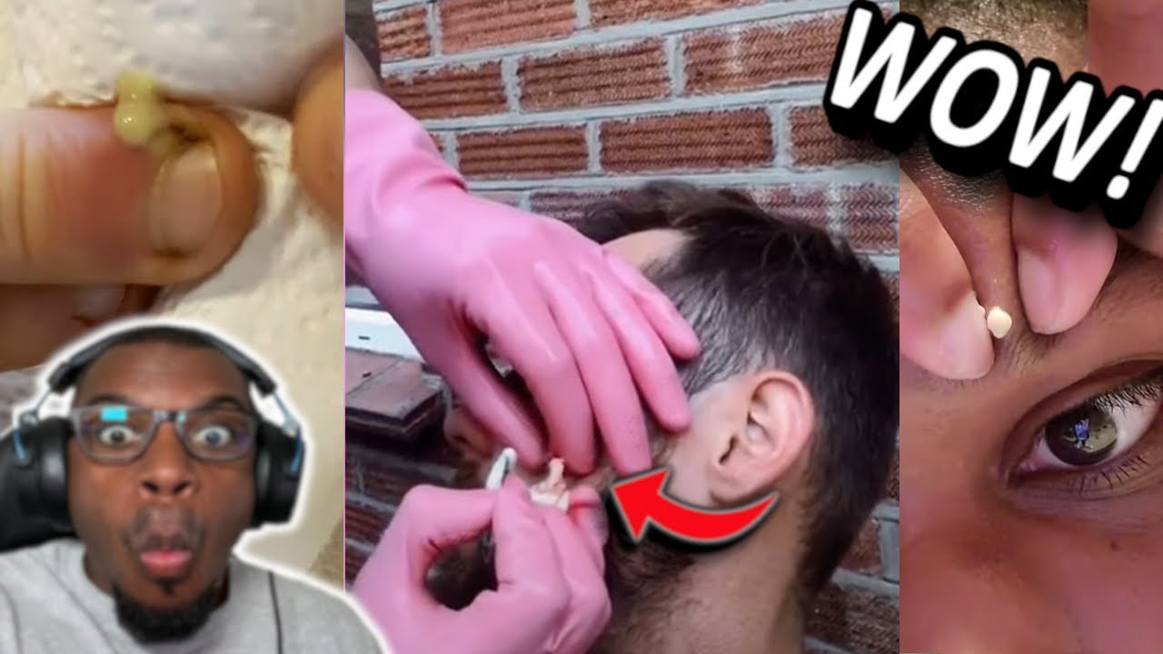 DO YOU SEE THE SIZE OF THAT CYST ON HIS FACE?! | Pimple Popping ...
