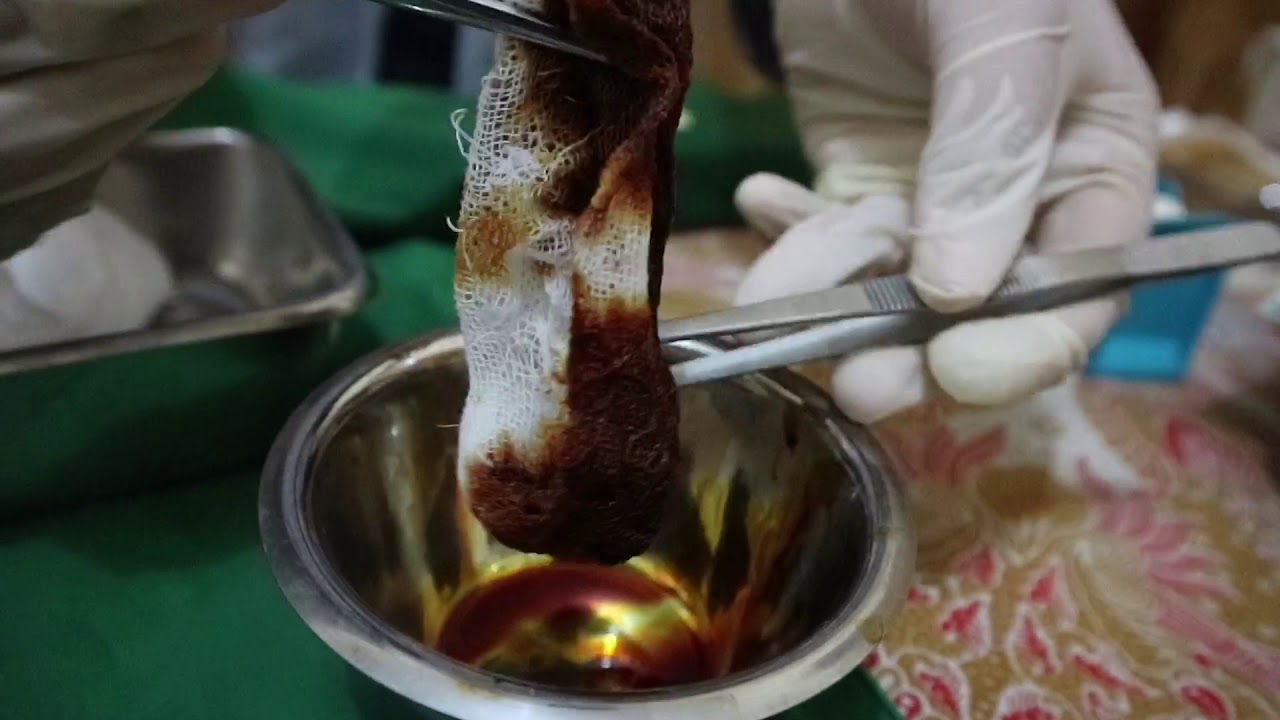 Keterampilan Klinik — Jahit luka & pengambilan benang jahit - YouTube