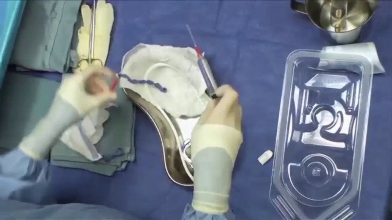 HeartMate 3 Implantation - YouTube