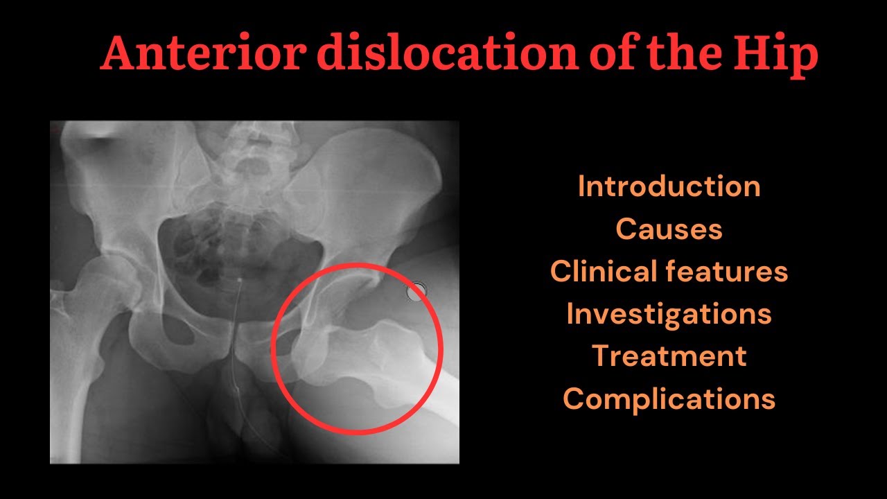 Anterior dislocation of hip: Causes, Clinical features, Treatment ...
