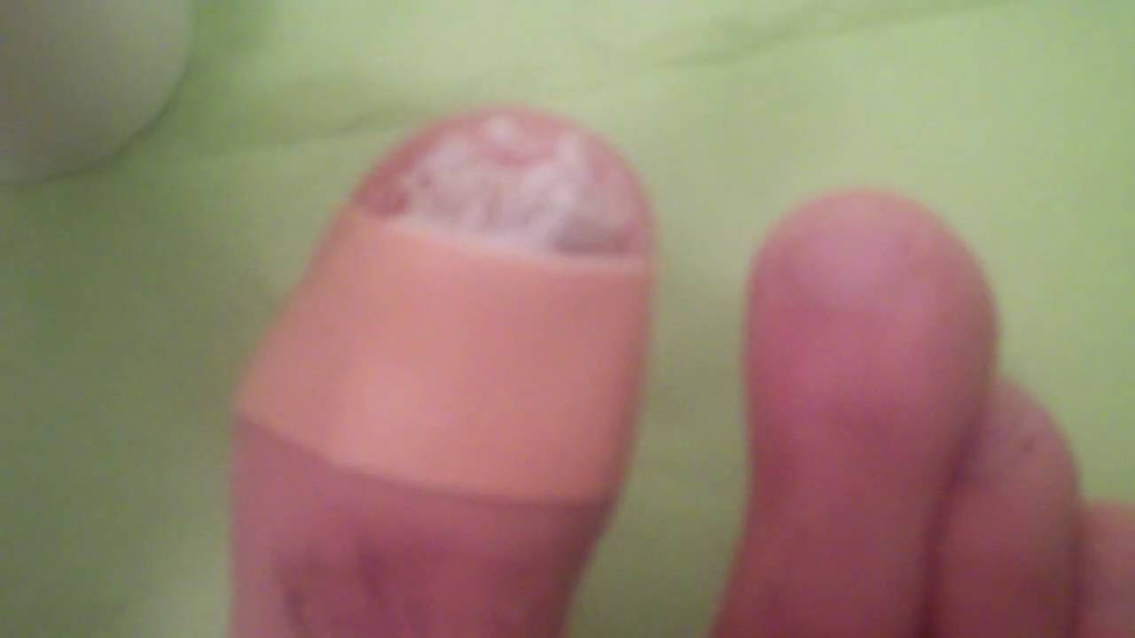 TOENAIL FUNGUS DOCUMENTARY DAY 4 - YouTube