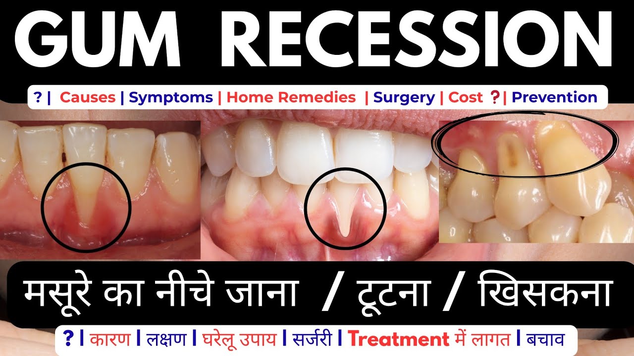 Why Are My Gum Receding ? / मसूरे नीचे क्यों जा रहे.? How to Stop Gum ...