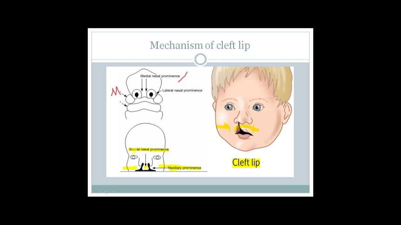 How cleft lip and cleft palate occurs (For USMLE step 1)?? - YouTube