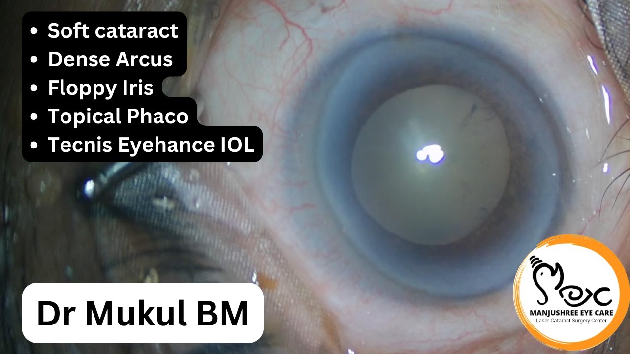 Hide & seek of nucleus piece (Arcus + Floppy Iris) - YouTube