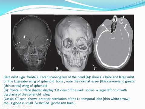 tau sign, pancake brain, harlequin appearance, the bare orbit sign ...