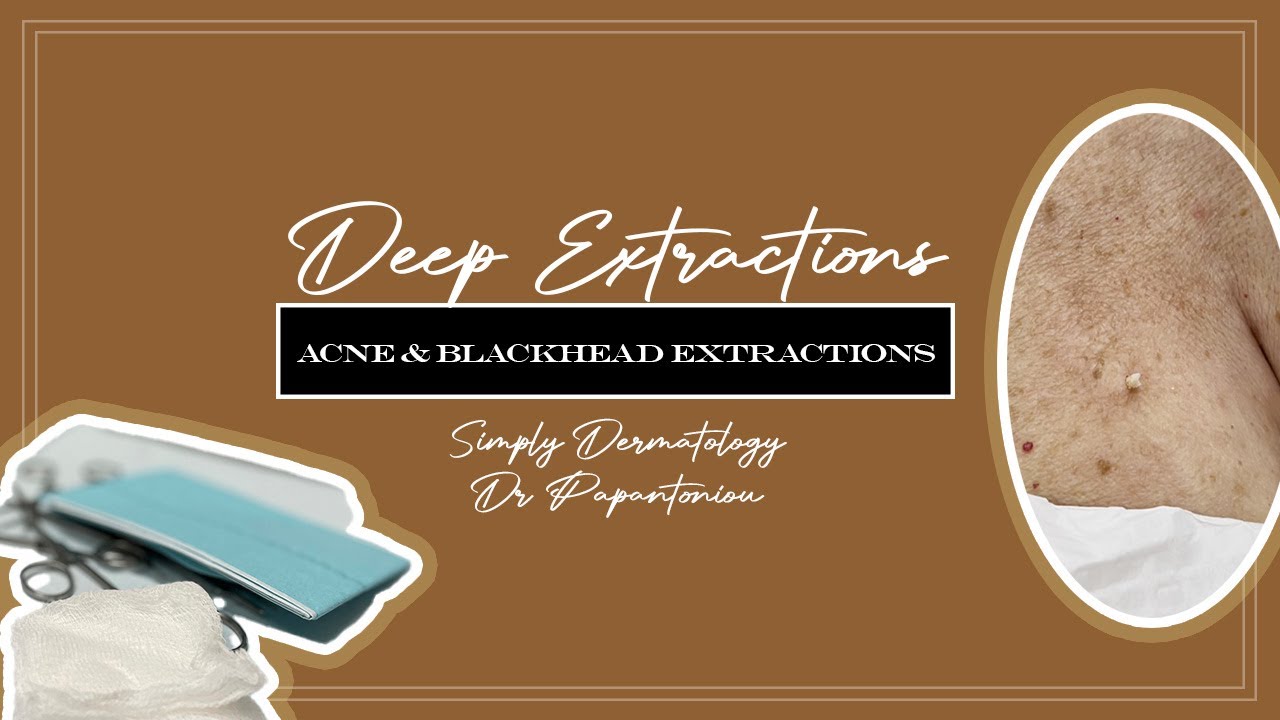 Deep Acne and Blackhead Extractions | Simply Dermatology | Dr Kally ...