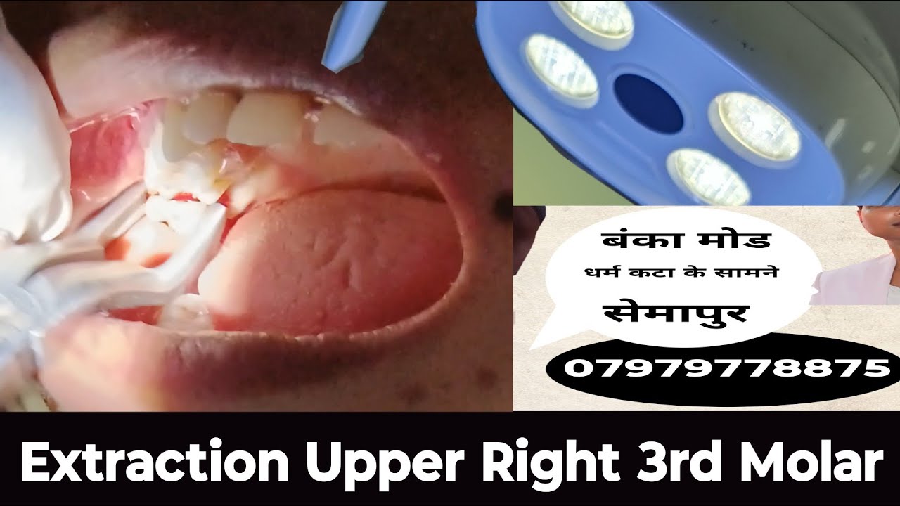 Upper Right 3rd Molar Extraction | Impacted upper Right 3rd Molar ...