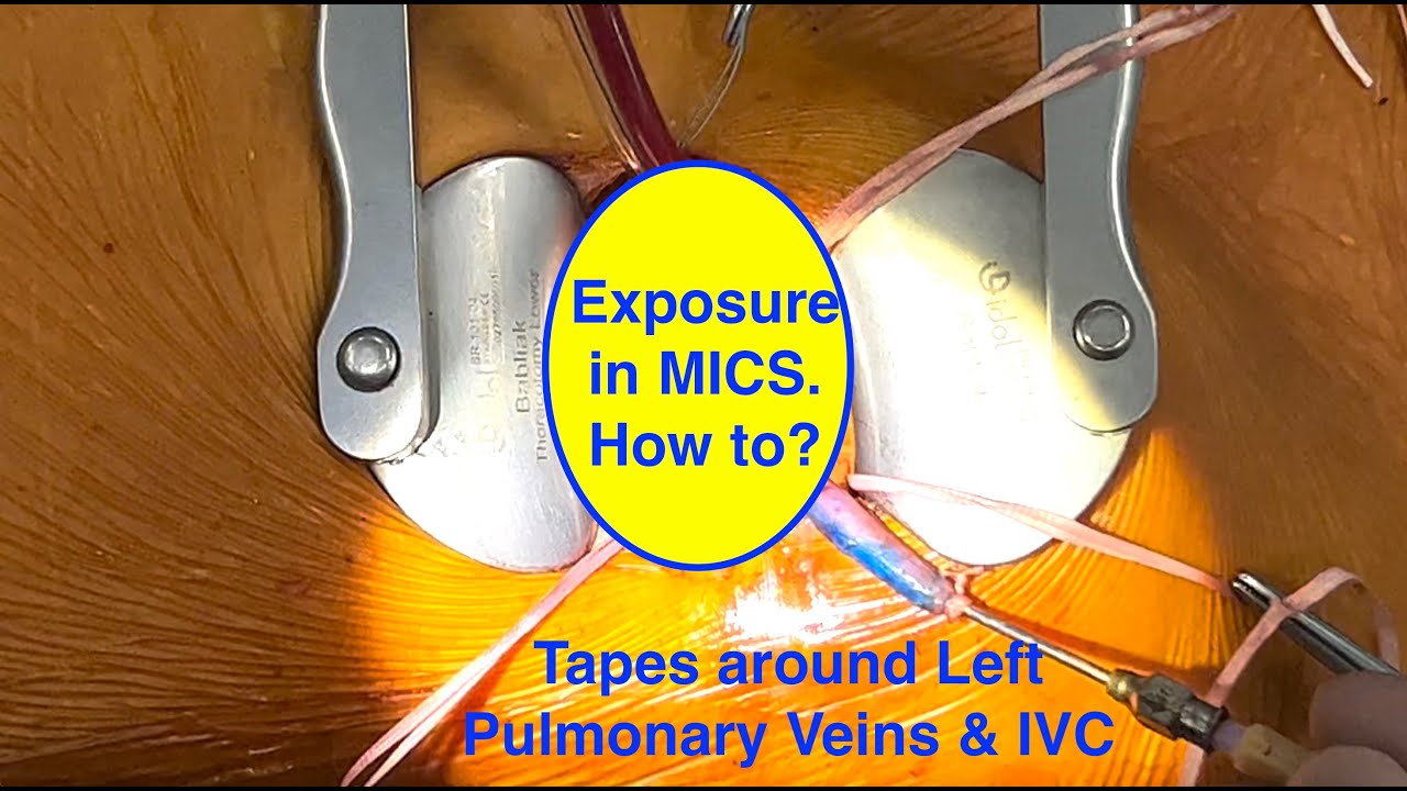 How to put the tapes for coronary vessels exposure? - YouTube