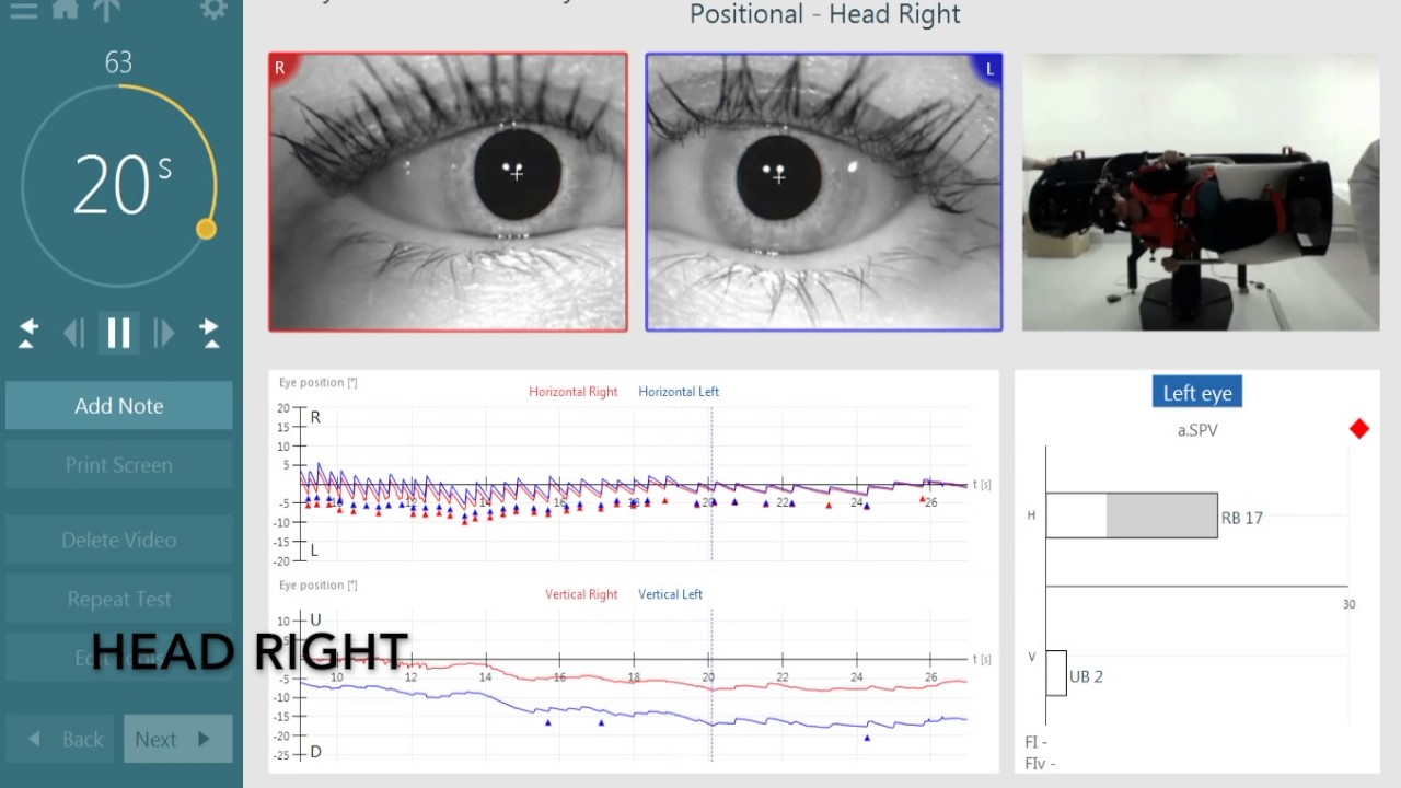 BPPV Assesment with the new TRV Chair by Interacoustics - YouTube