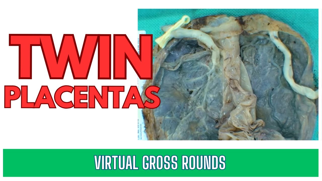 Grossing Twin Placentas with Twin to Twin Transfusion Syndrome ...