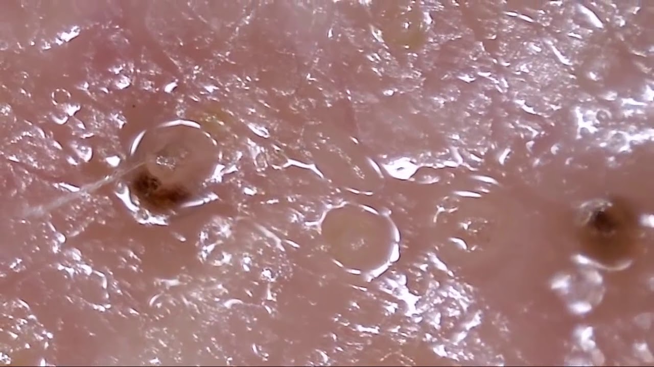 Demodex Mites In Human Skin