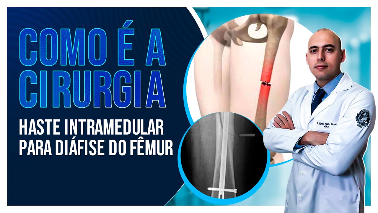 HASTE INTRAMEDULAR PARA DIÁFISE DO FÊMUR (anterógrada) | COMO É A ...