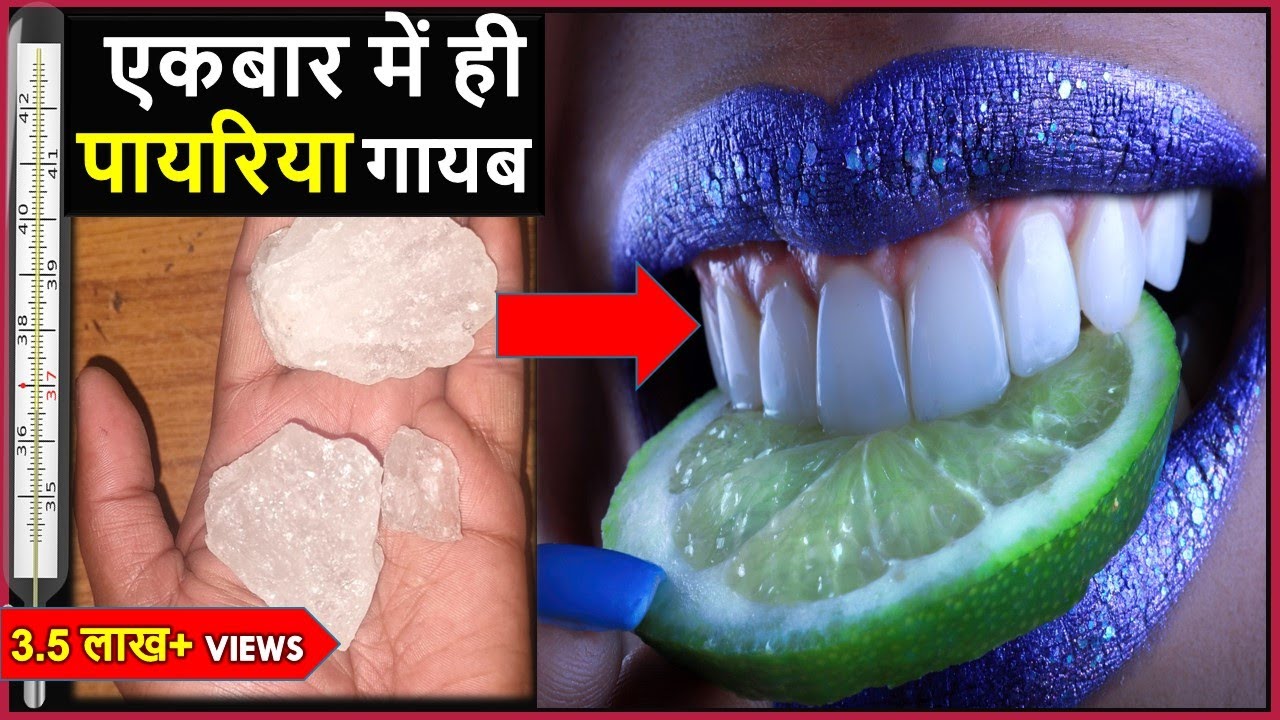 पायरिया रोग का रामबाण और पक्का इलाज | Ghar pe payariya ko kaise thik ...
