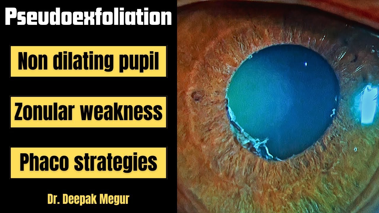 Phaco in a eye with Rigid Non Dilating Pupil with Pseudoexfoliation and ...