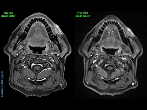 Twist Vibe Head Neck Imaging - YouTube