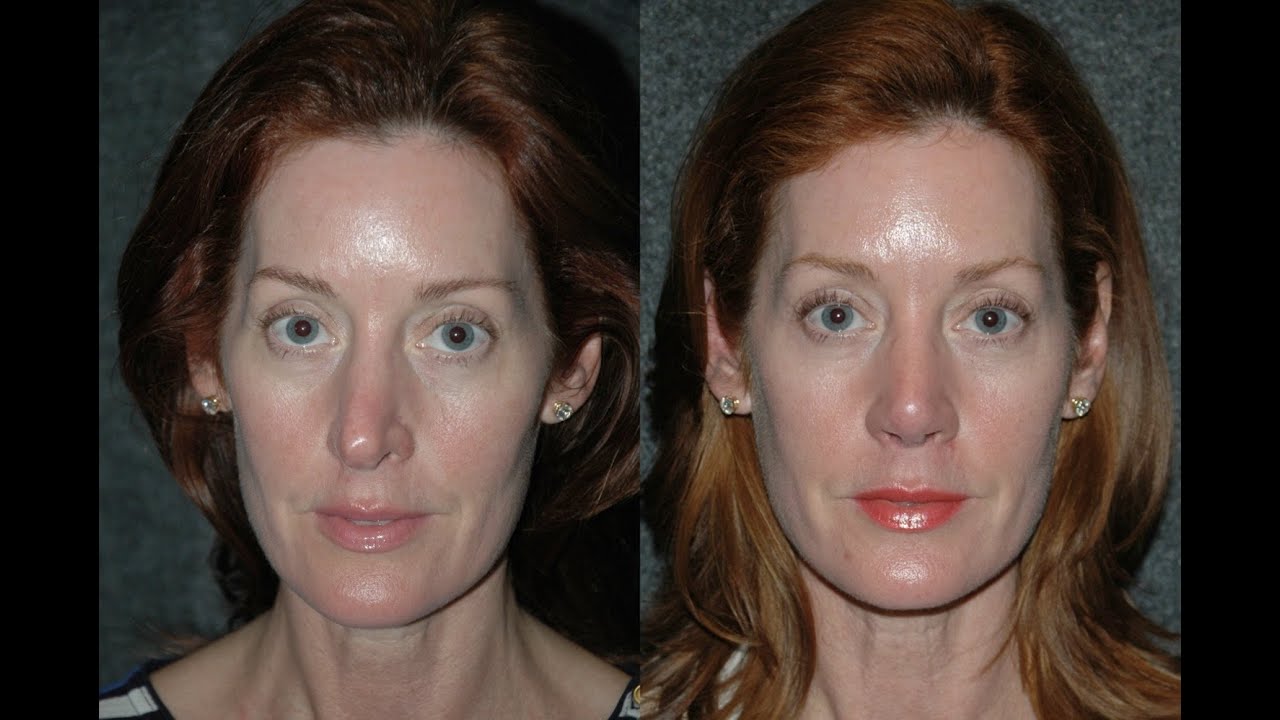 Revision Rhinoplasty Surgery for a Female Model by Dr Andrew Jacono # ...