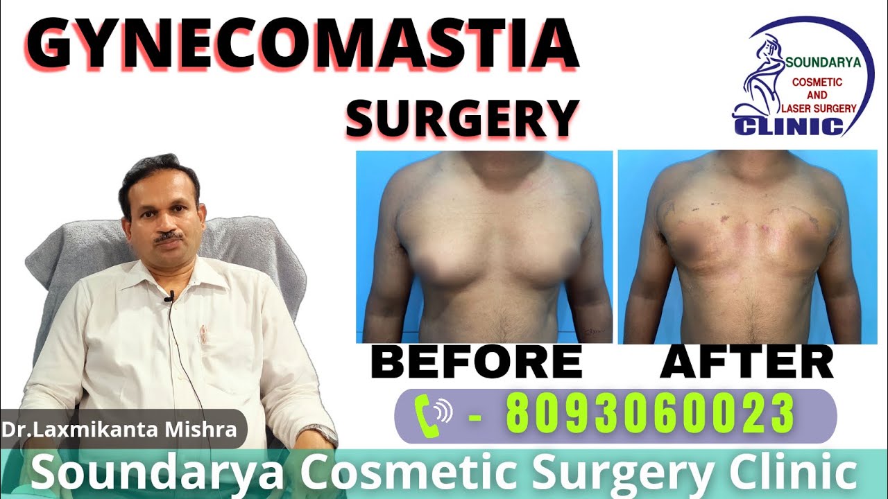 Gynecomastia surgery at Soundarya clinic patients Feedback video/ Dr ...