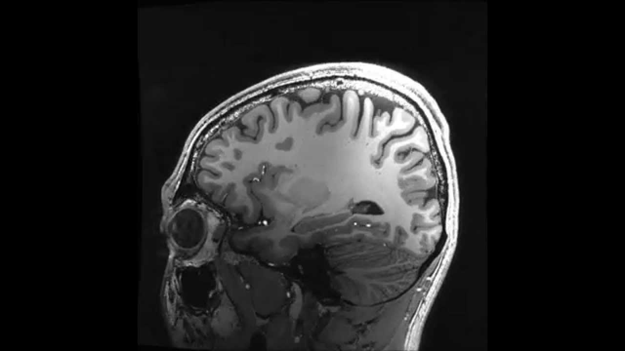 Highest Resolution In Vivo Human Brain MRI Using Prospective Motion ...