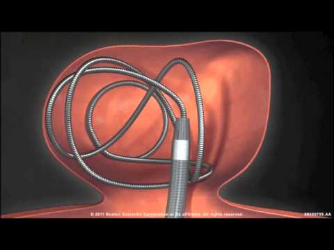 Embolizacja klasyczna - YouTube