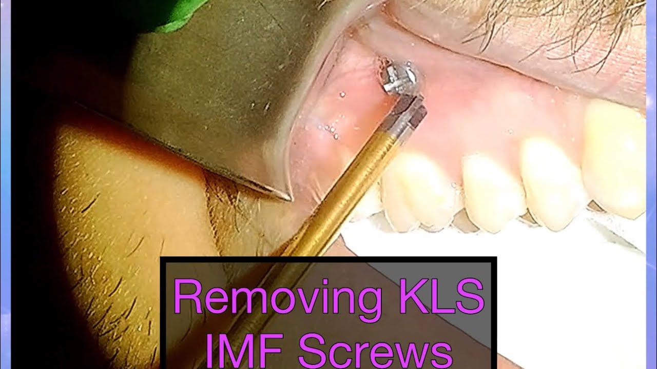 Long Version IMF Screw Removal for Closed Reduction of Mandible ...