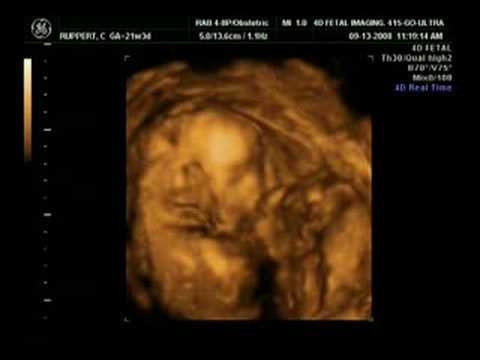 4D Ultrasound at 22 Weeks - YouTube