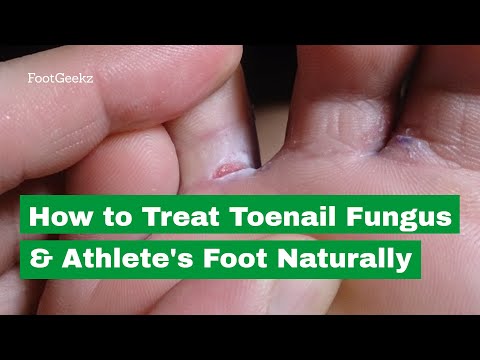 How to Treat Toenail Fungus & Athlete's Foot Naturally