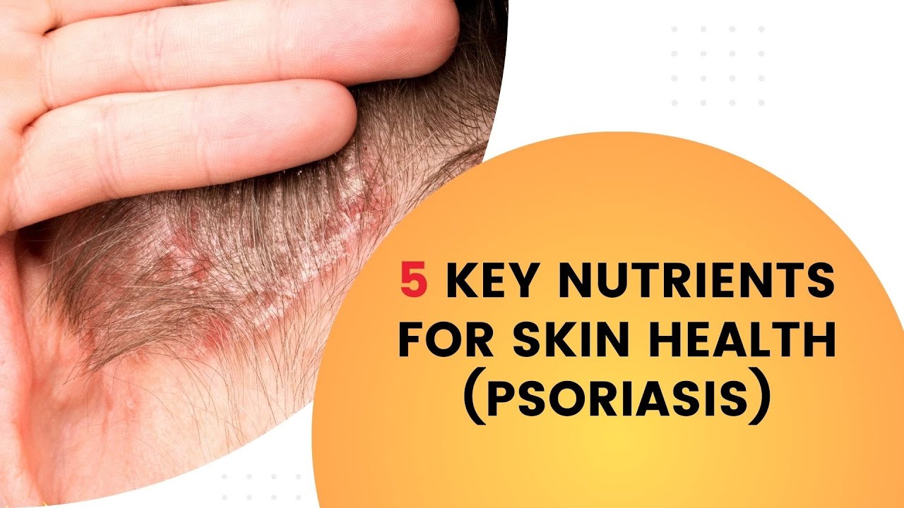 5 Key Nutrients for Skin Health Psoriasis - YouTube