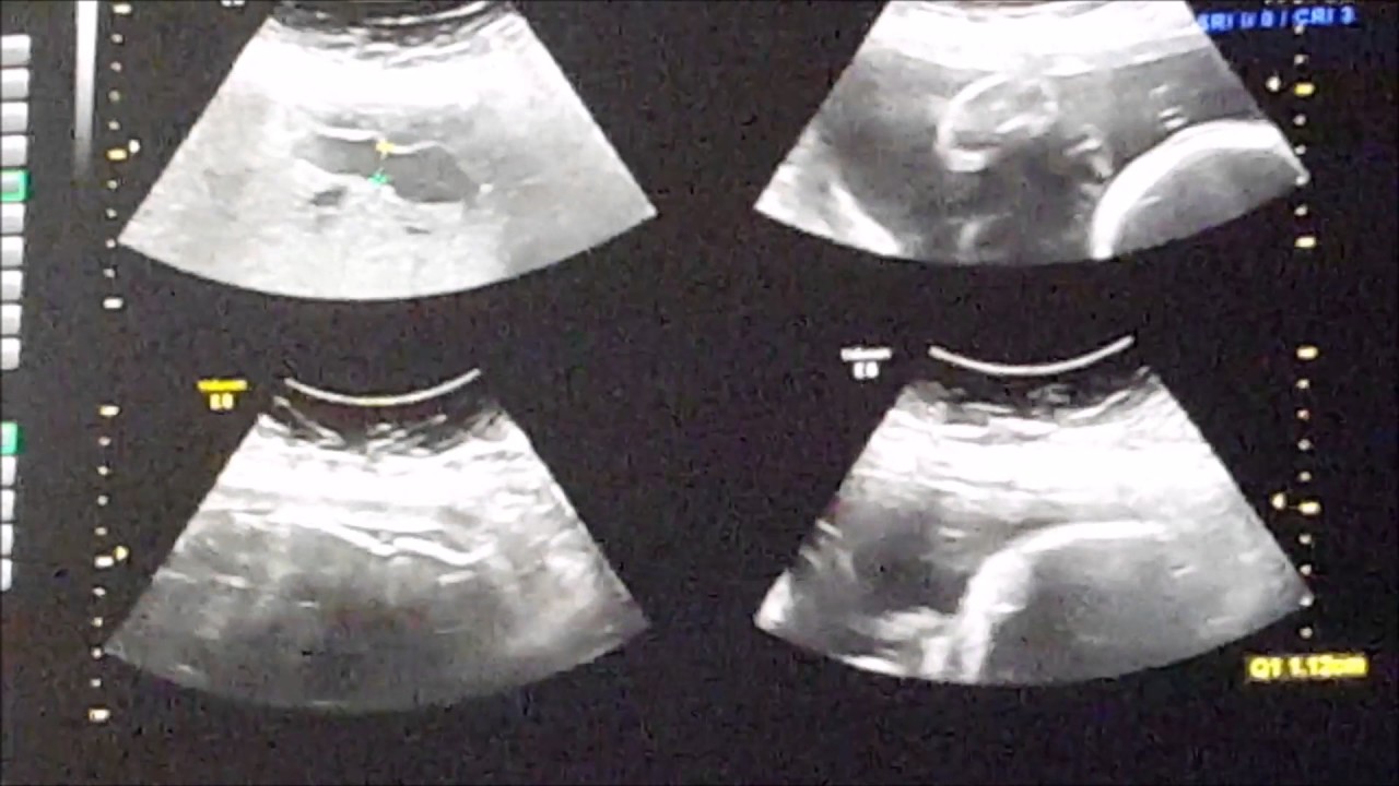 Baby London's 31 Week Ultrasound And Update 4/25/2017 - YouTube