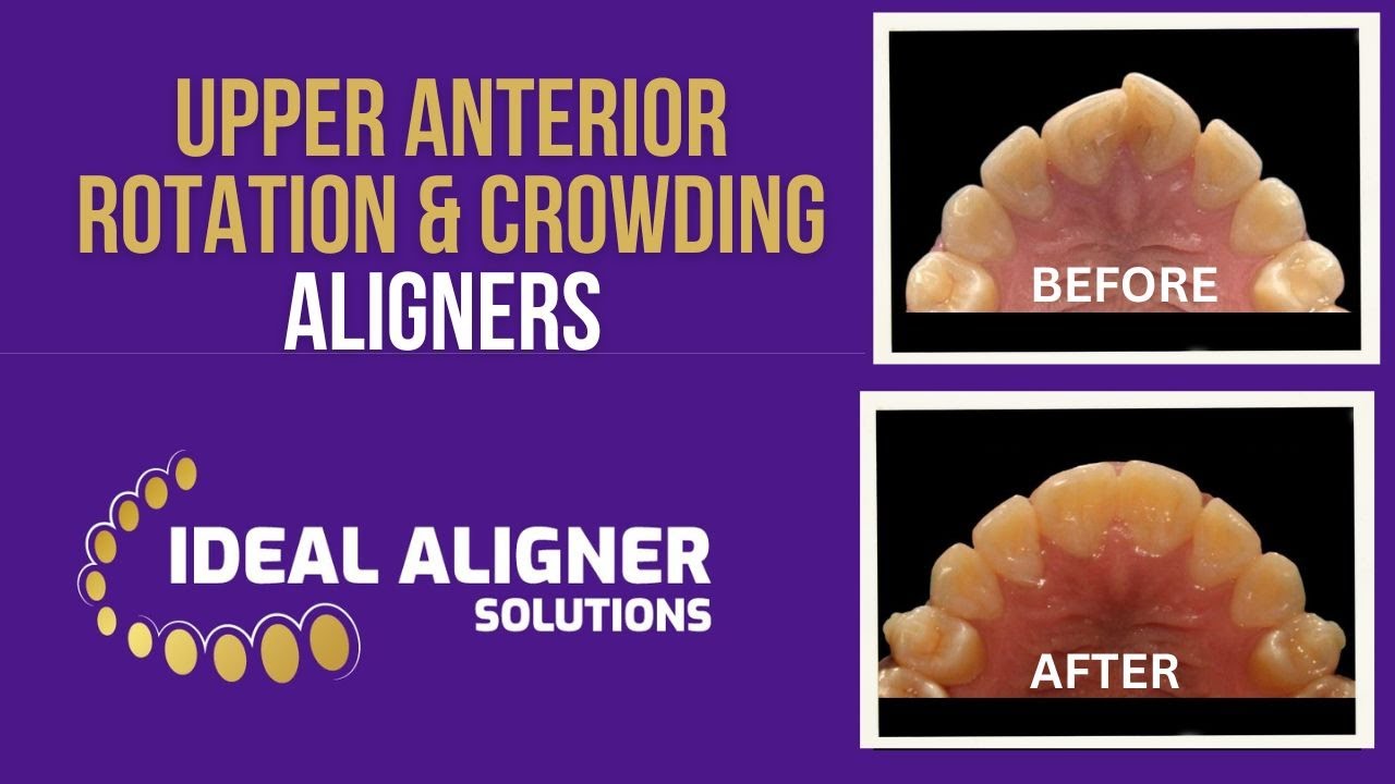 Anterior dental crowding correction-aligners/ideal aligner solution ...