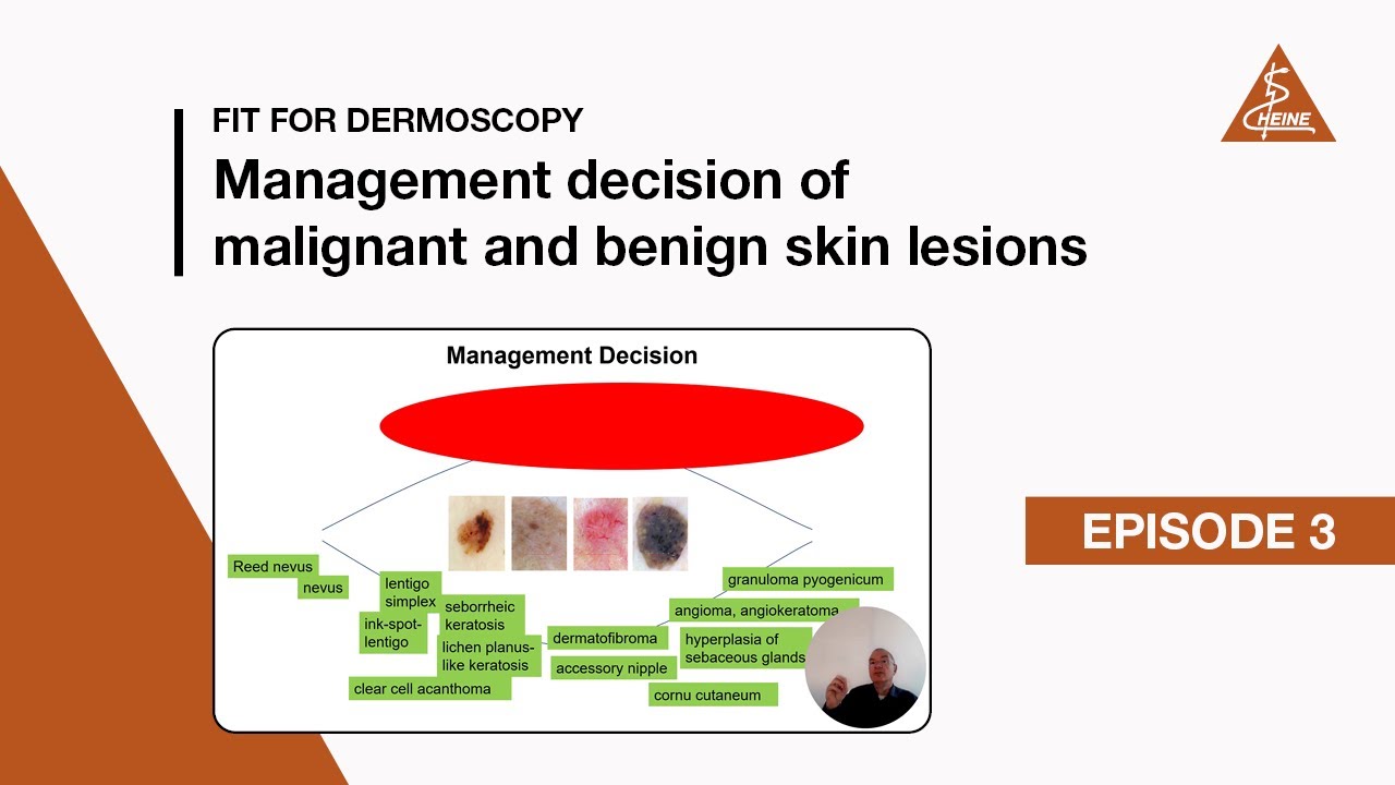 Fit for Dermoscopy Episode 3 — Making executive decisions concerning ...
