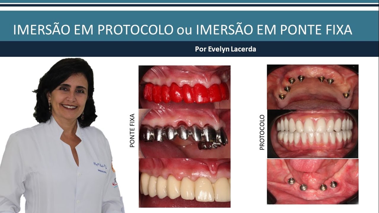 Ponte fixa ou protocolo Branemark #159 - YouTube