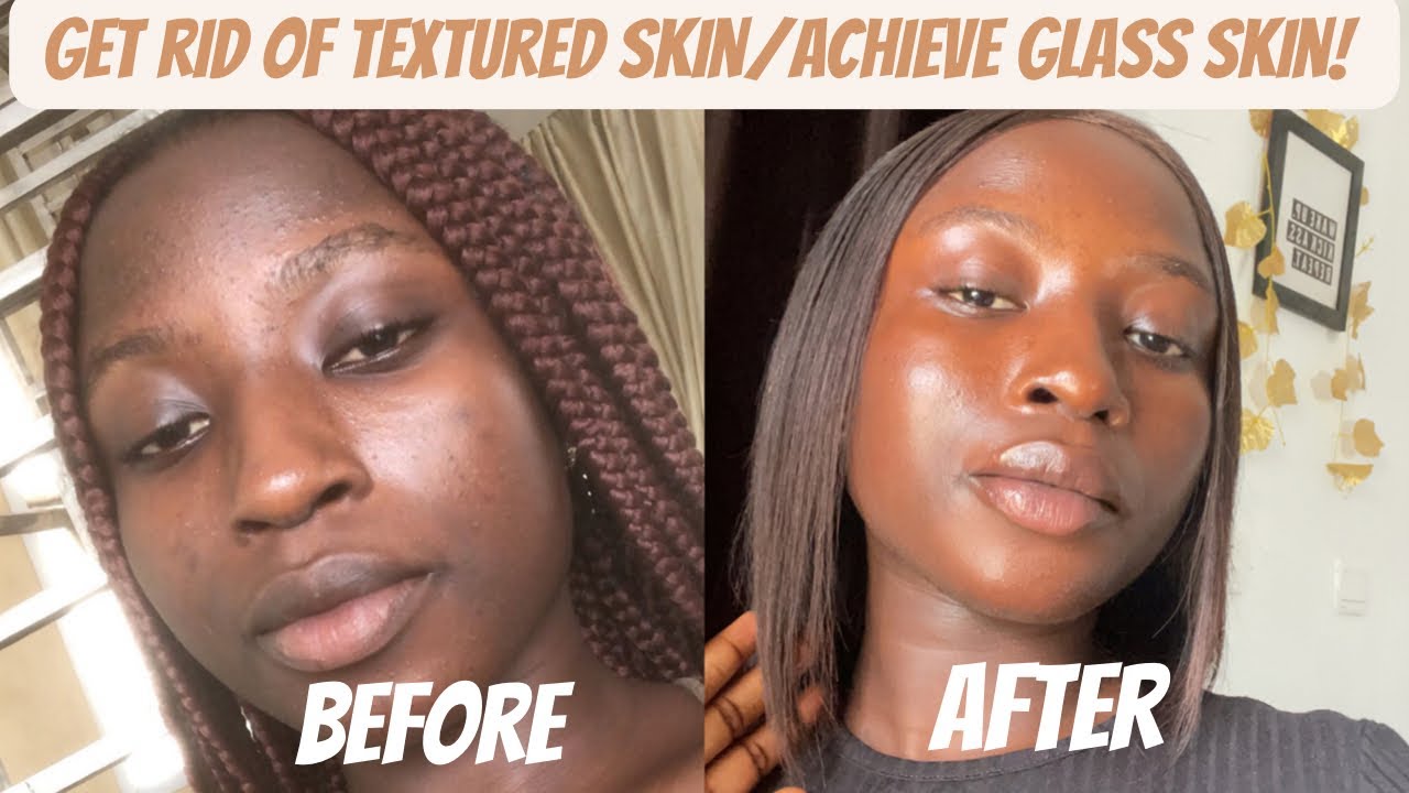 HOW I GOT RID OF MY ROUGH BUMPY SKIN| HOW TO GET RID OF TEXTURED SKIN# ...