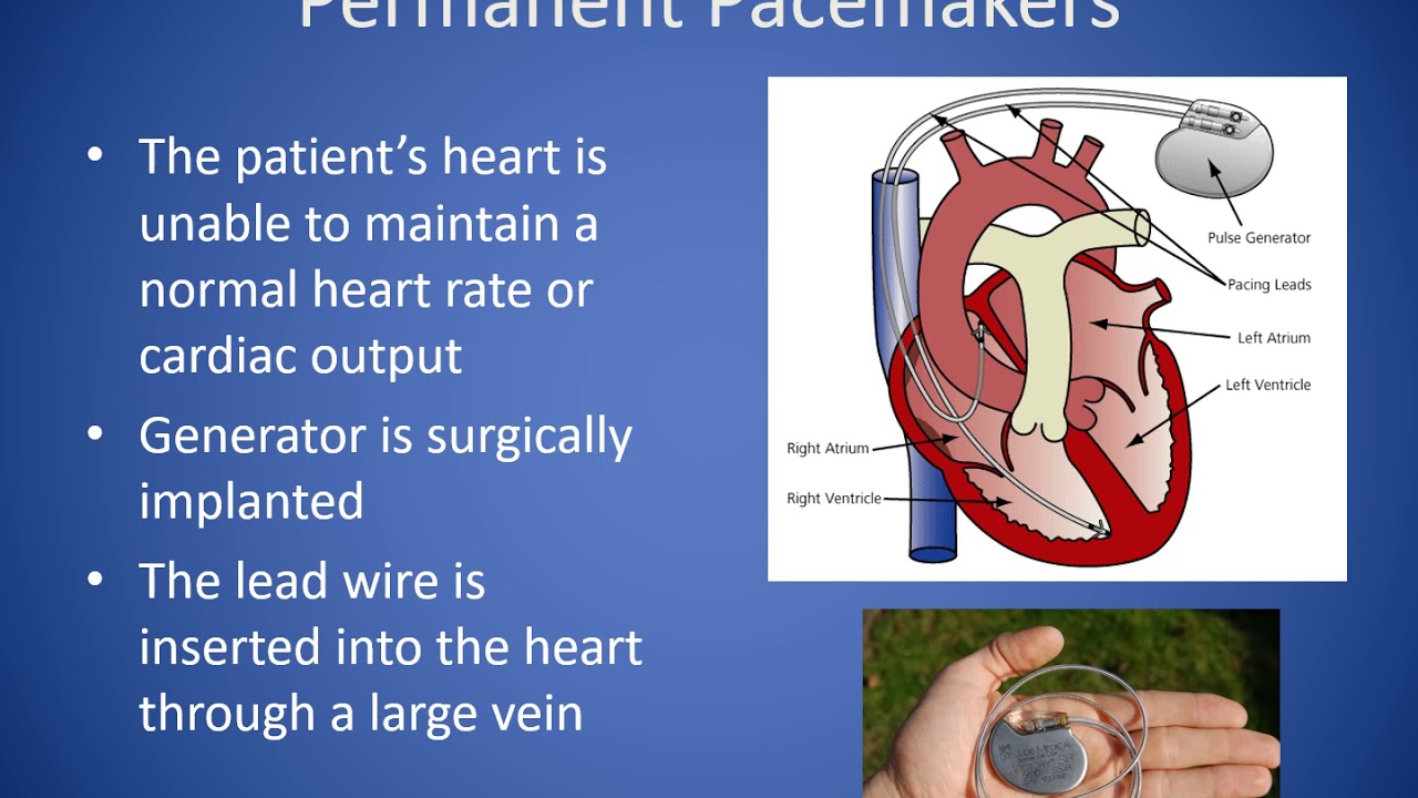 Pacemakers video - YouTube