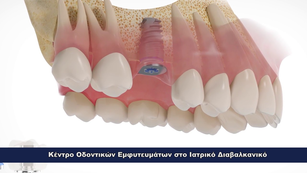 Κέντρο Οδοντικών Εμφυτευμάτων στο Ιατρικό Διαβαλκανικό - YouTube