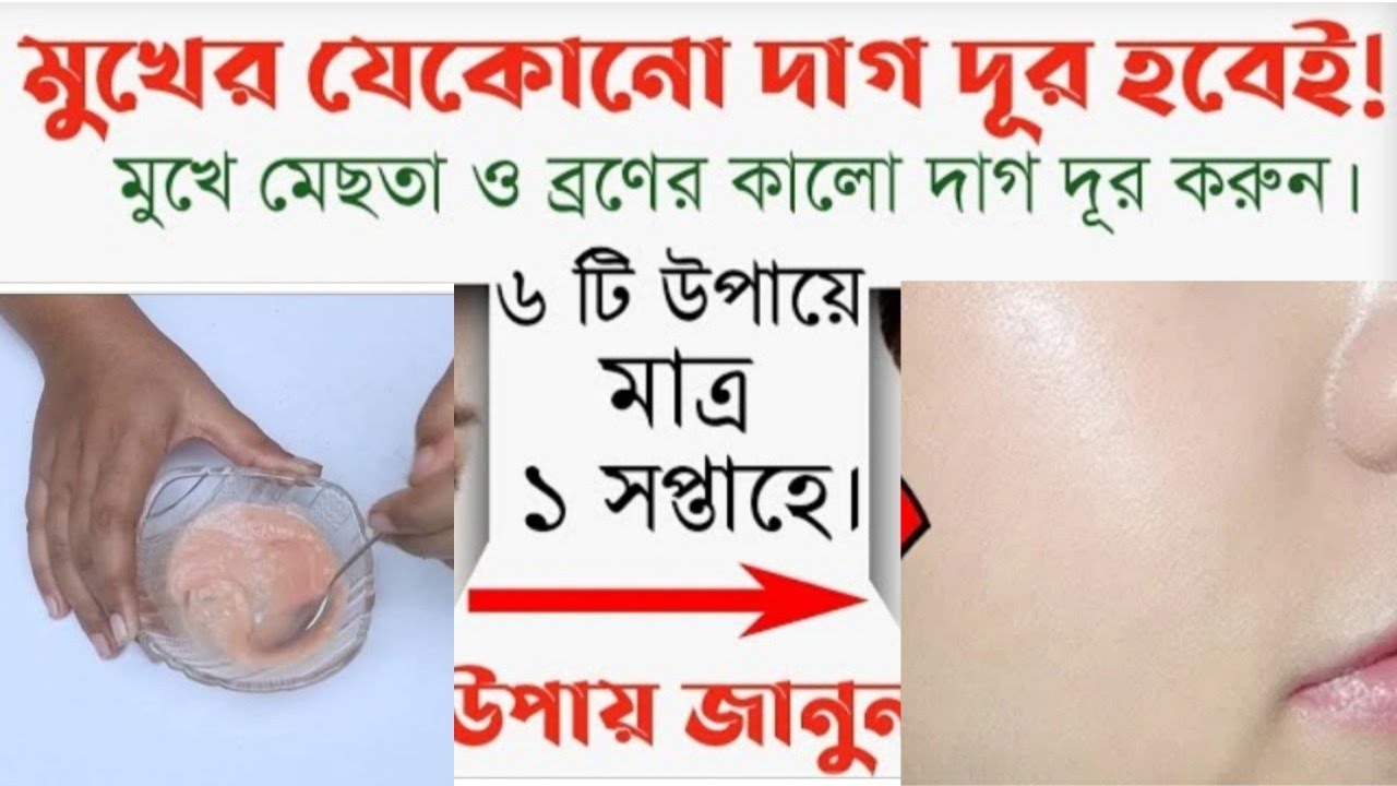 7 দিন এ মুখের কালো দাগ দূর করার উপায় | kalo dag dur korar upay bangla ...