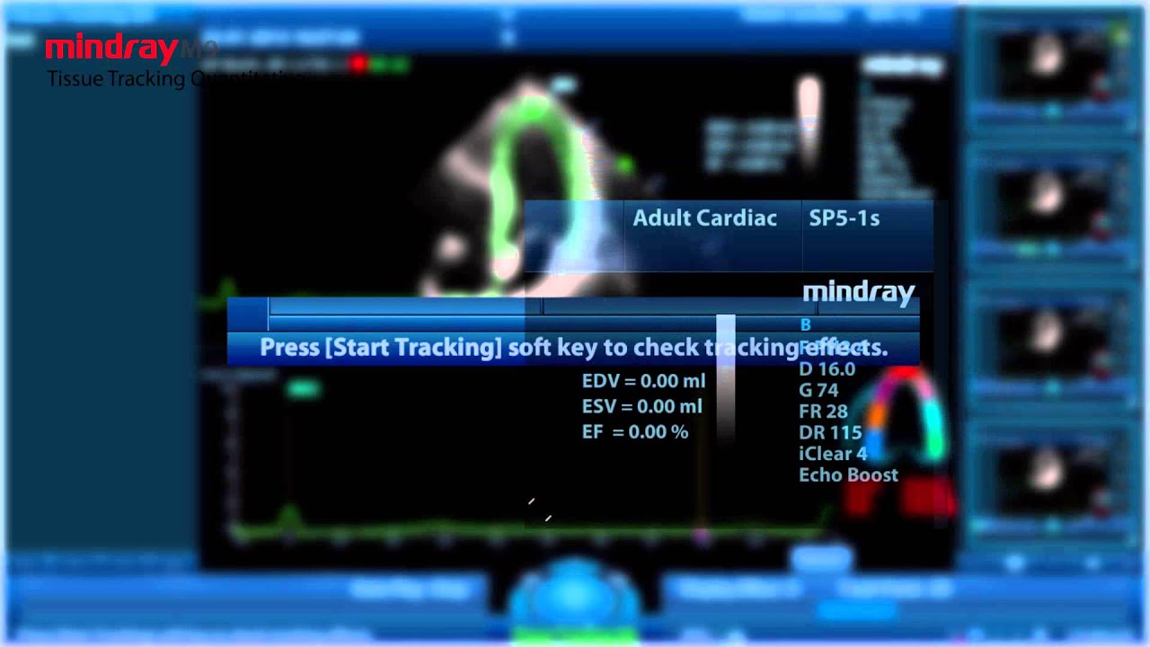 Tissue Tracking Quantitative on Mindray M9 with Dr. Leopoldo Pérez de ...